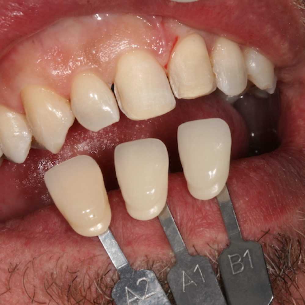 Quanto custam facetas dentárias de porcelana ou cerâmica